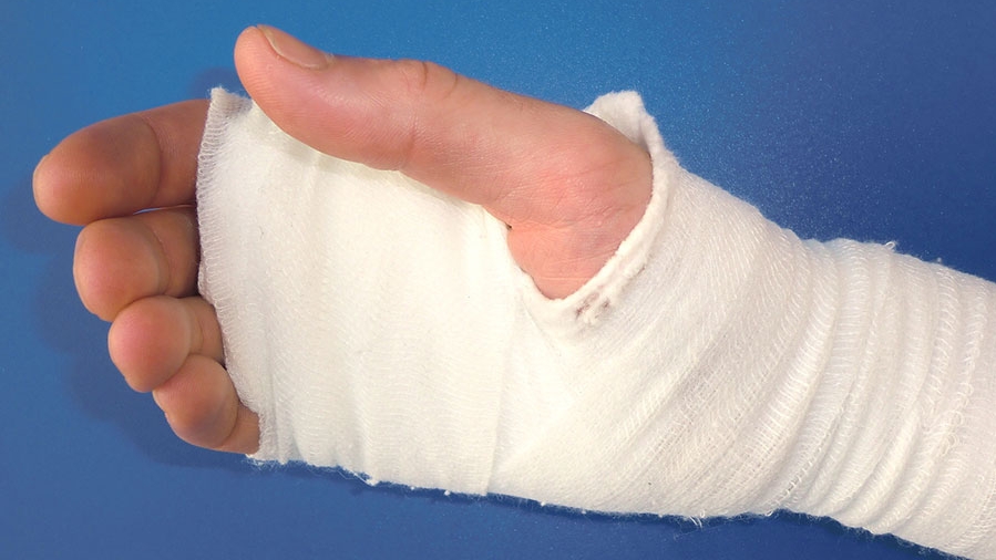 Komplexe Handverletzungen Zusammenarbeit dringend gefragt | Sichere Arbeit